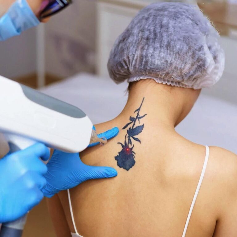 Certificate Program In Tattoo Removal - vlccinstitutegachibowli.com